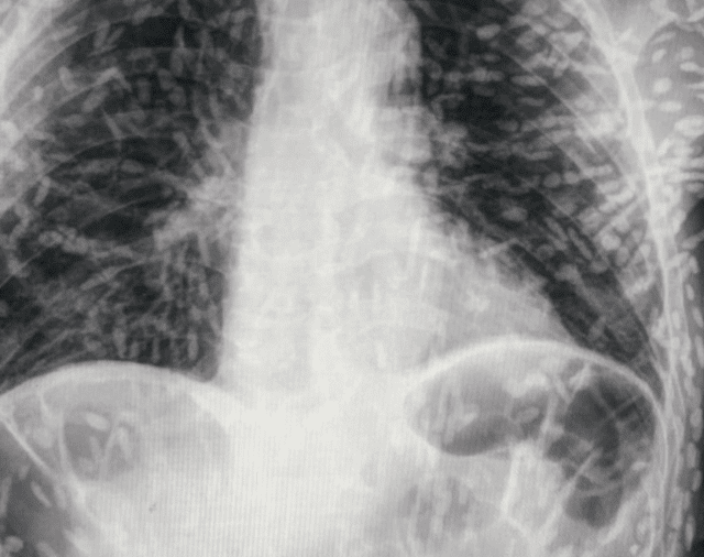 cisticercose muscular | W Radio Brasil